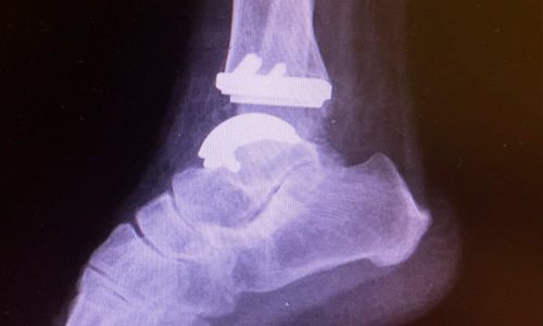 Prótese de Tornozelo - Dr. Leandro M. Miranda